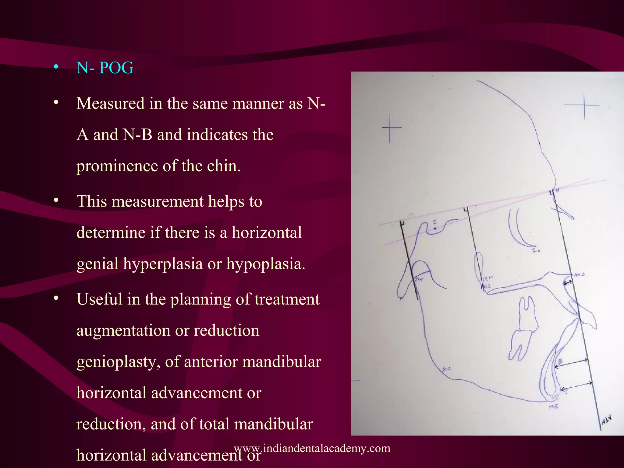 COGS analysis (Cephelometrics for orthognathic surgery) / fixed ...