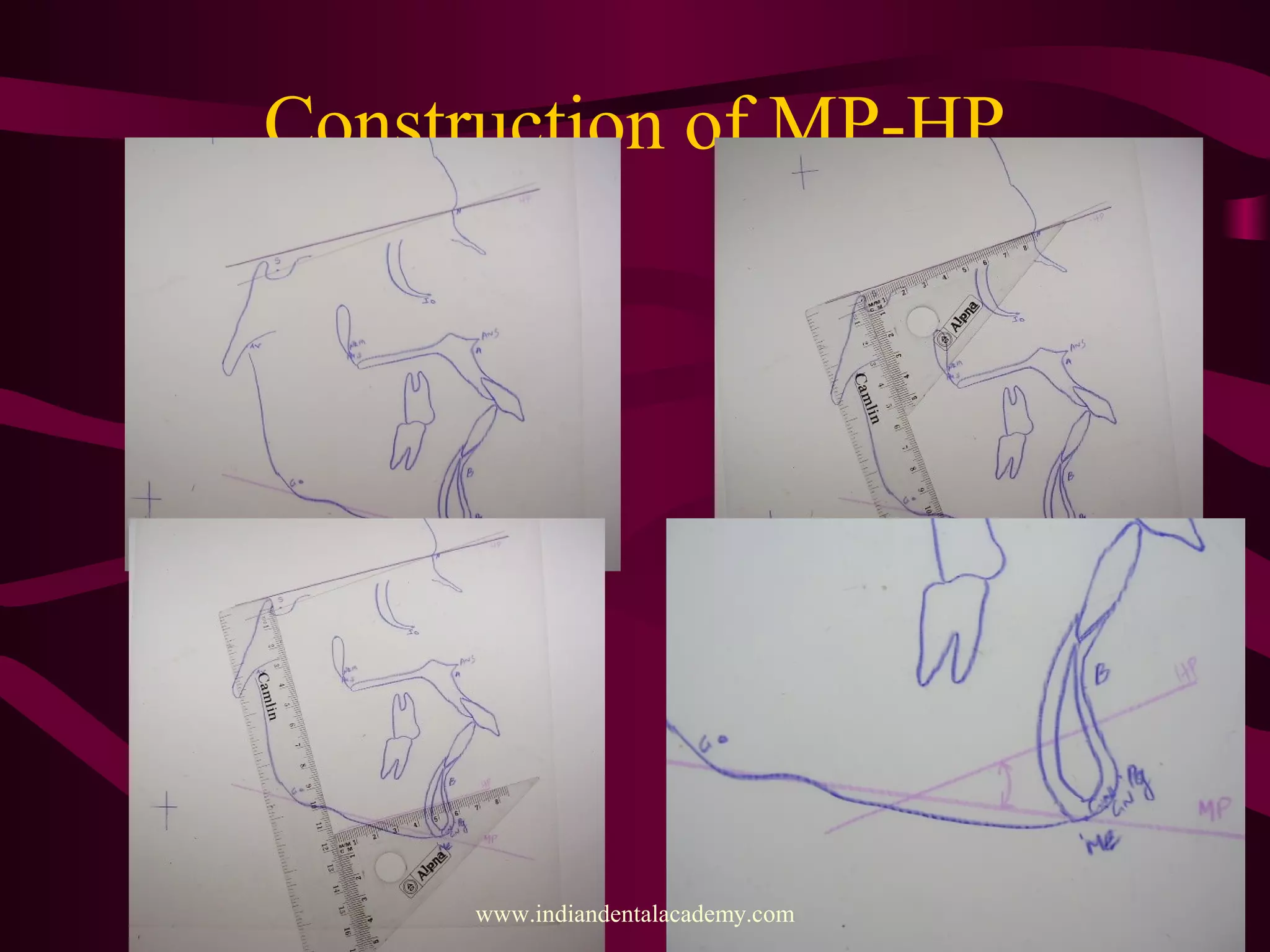 COGS analysis (Cephelometrics for orthognathic surgery) / fixed ...