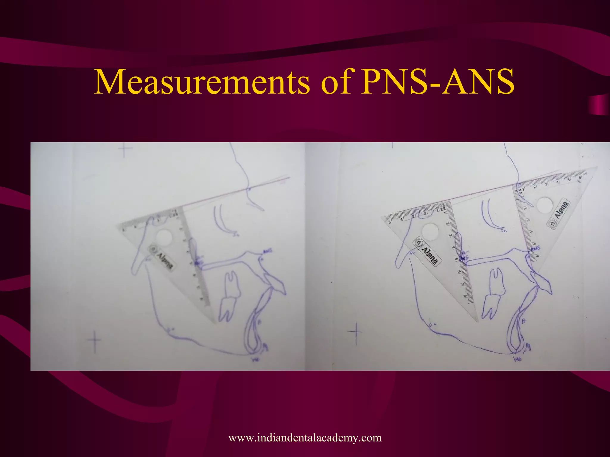 COGS analysis (Cephelometrics for orthognathic surgery) / fixed ...