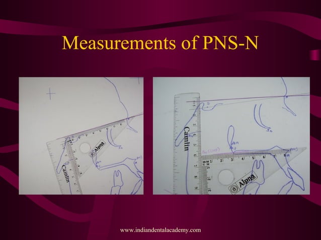 COGS analysis (Cephelometrics for orthognathic surgery) / fixed ...