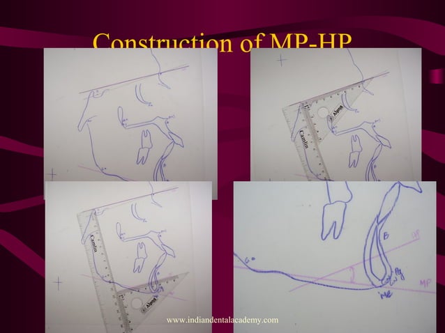 COGS analysis (Cephelometrics for orthognathic surgery) / fixed ...