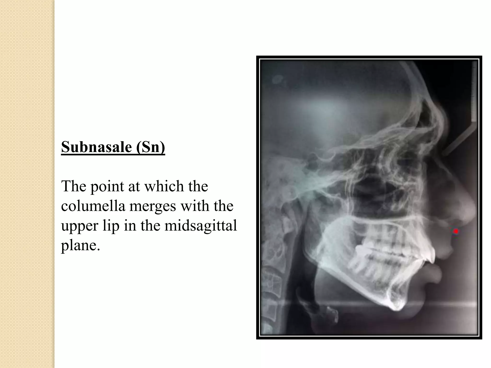 BURSTONE ANALYSIS : C.O.G.S (SOFT TISSUE) | PPTX