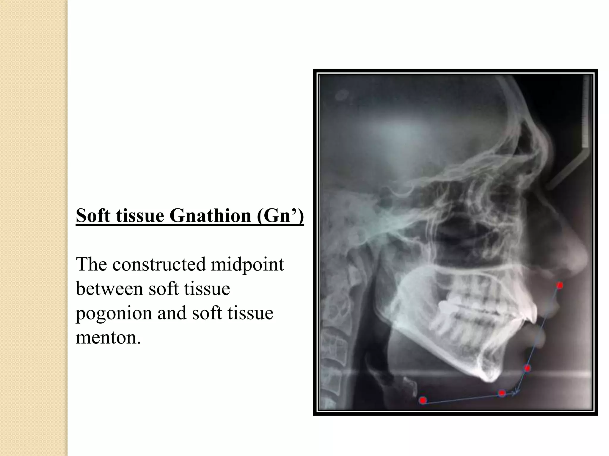 BURSTONE ANALYSIS : C.O.G.S (SOFT TISSUE) | PPTX
