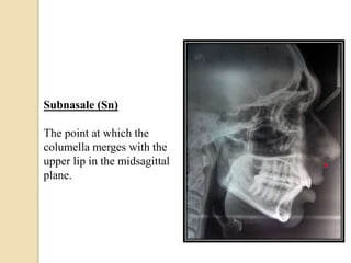 BURSTONE ANALYSIS : C.O.G.S (SOFT TISSUE) | PPTX