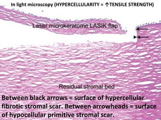 Cohesive tensile strength of human lasik wounds | PPT