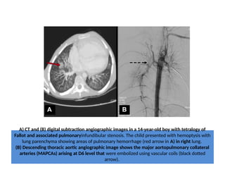 Coiling of Major Aortopulmonary Collateral Arteries (MAPCAs.pptx