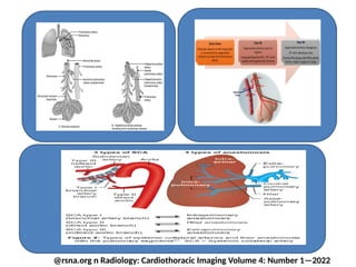 Coiling of Major Aortopulmonary Collateral Arteries (MAPCAs.pptx