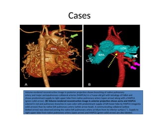 Coiling of Major Aortopulmonary Collateral Arteries (MAPCAs.pptx