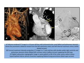 Coiling of Major Aortopulmonary Collateral Arteries (MAPCAs.pptx