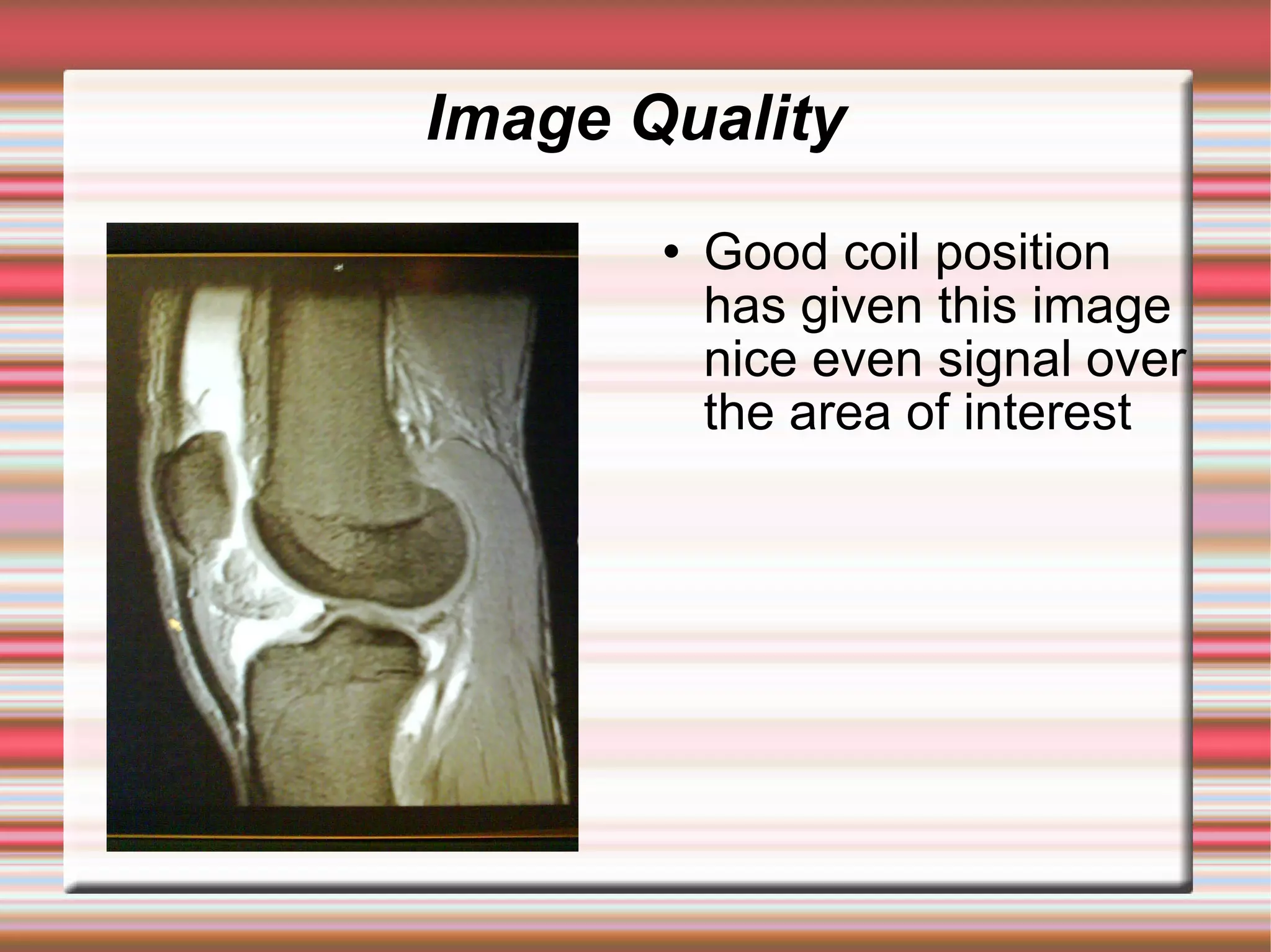 Coil Safe Positioning in MRI | PPT
