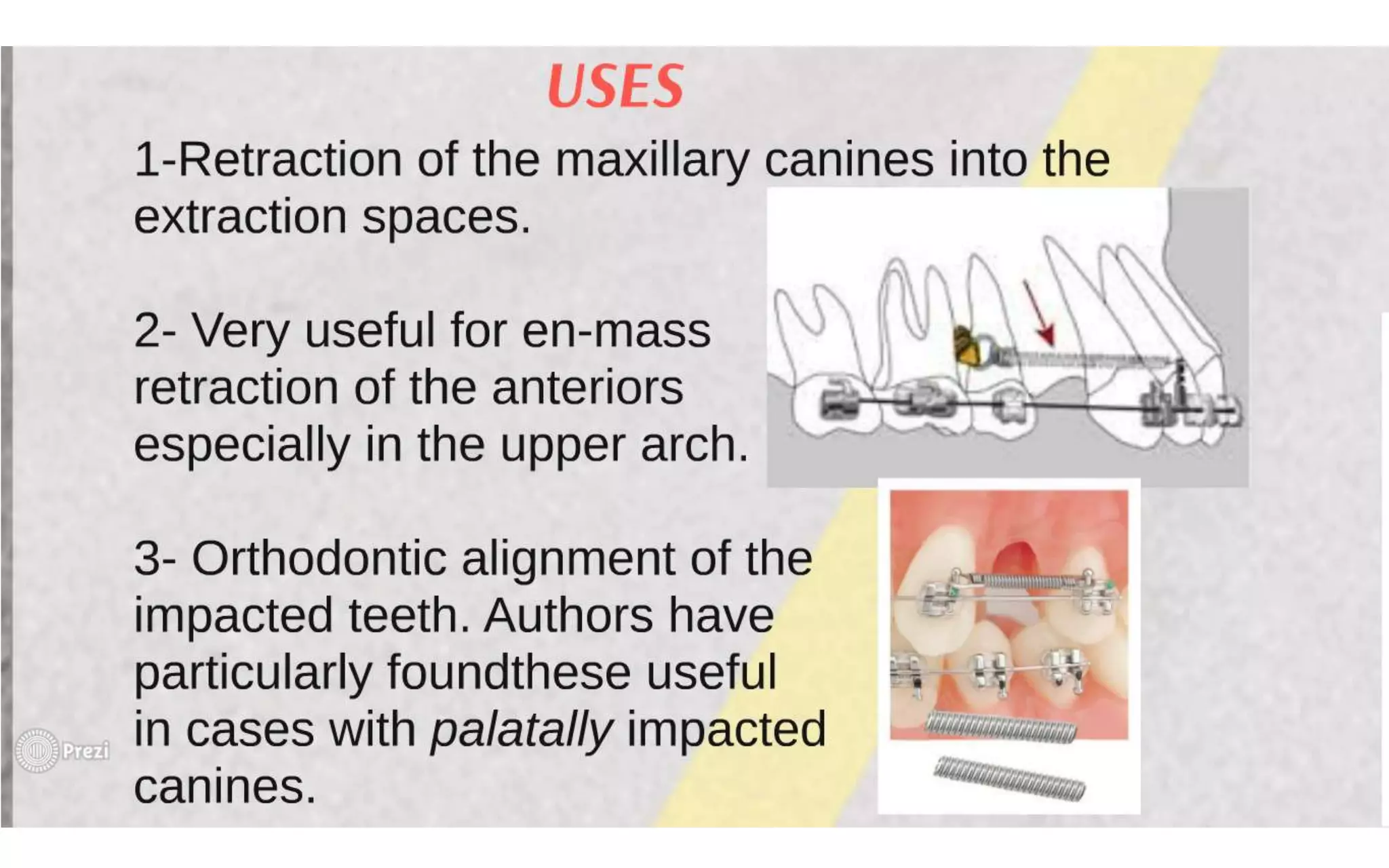 Orthodontic Coil spring | PPTX