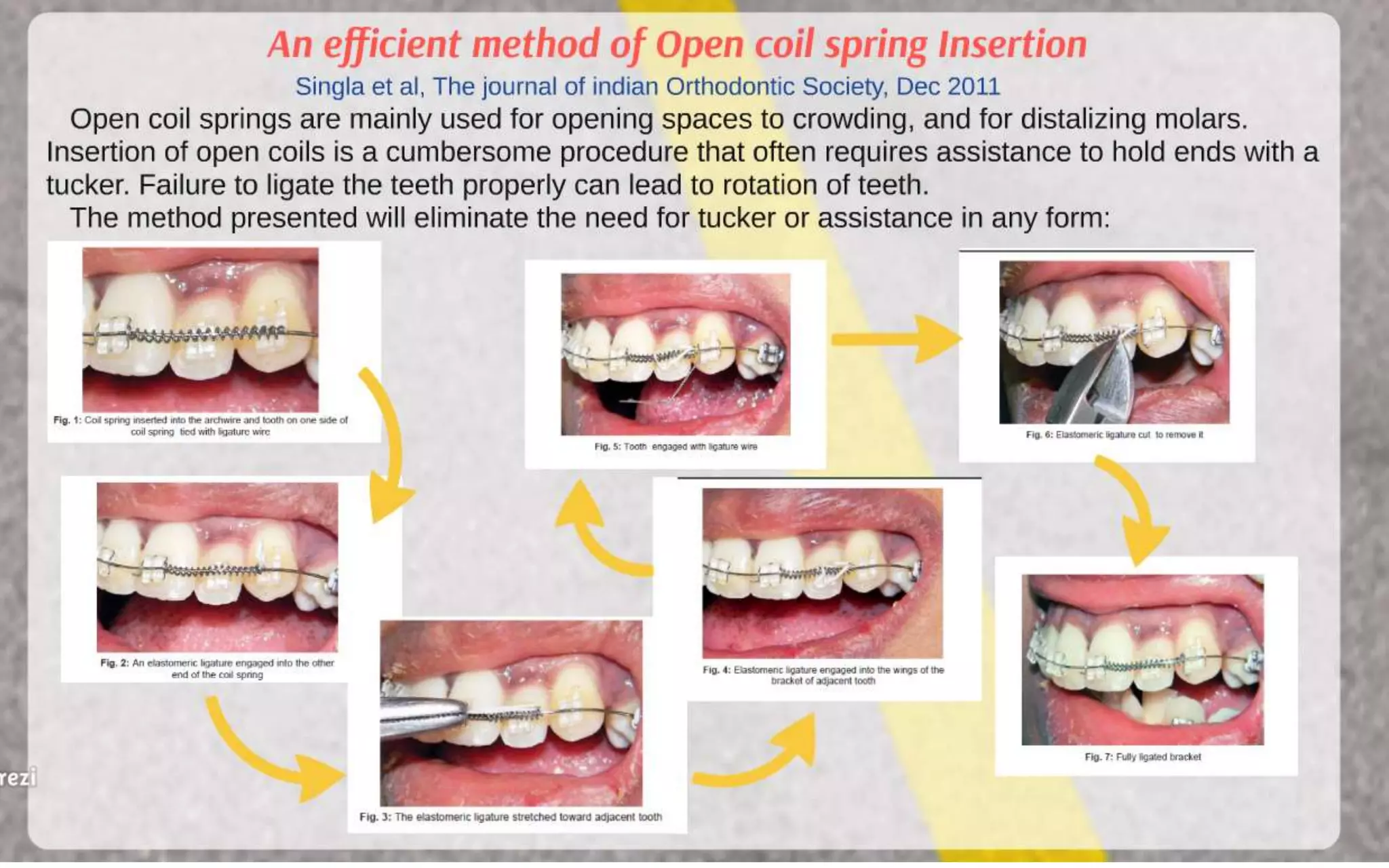 Orthodontic Coil spring | PPTX