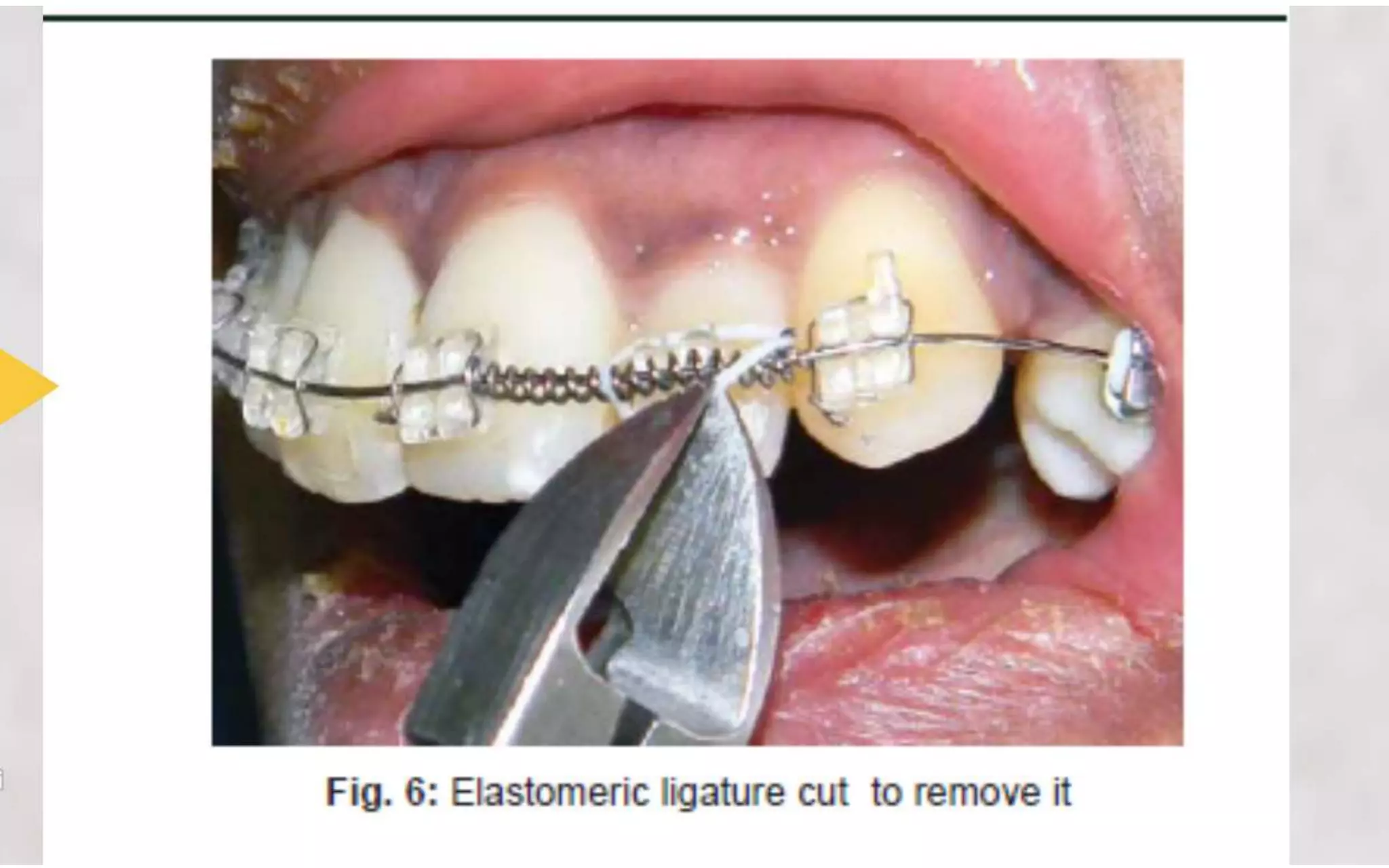 Orthodontic Coil spring | PPTX