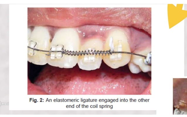 Orthodontic Coil spring | PPTX