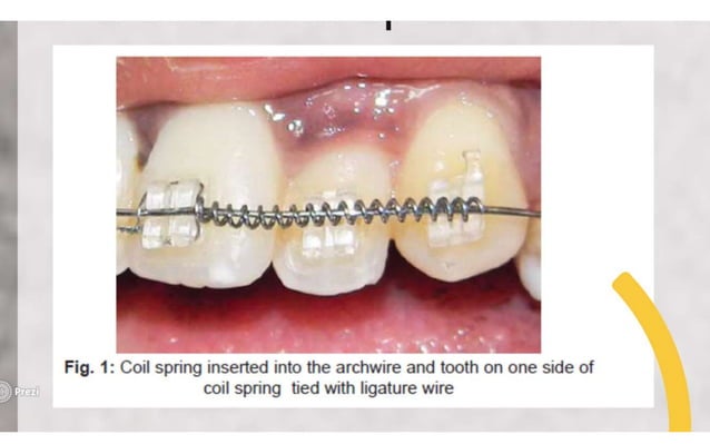 Orthodontic Coil spring | PPT