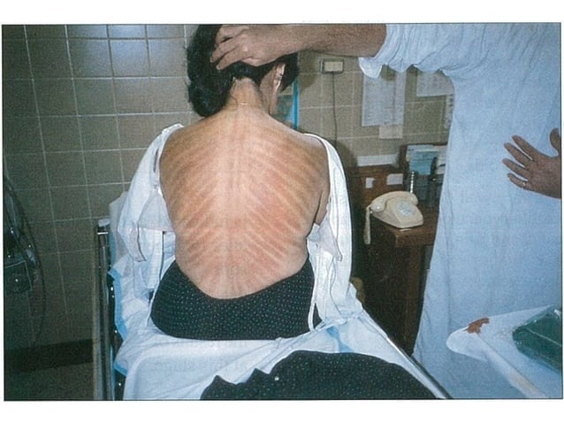 Coining therapy | PPT | Diseases and Conditions | Medical Health