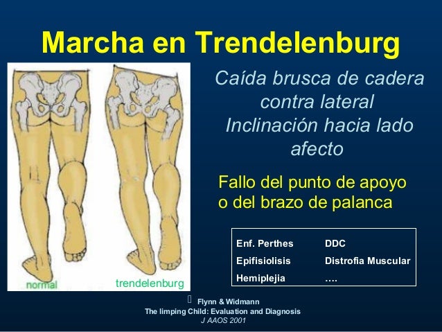 Cojera en el niño- evaluación y diagnostico