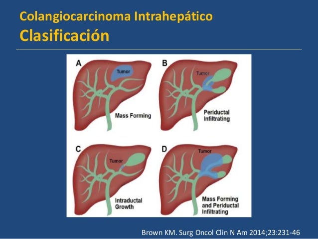 Colangiocarcinoma