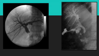COLANGIOGRAFIA POST -OPERATORIA.pptx