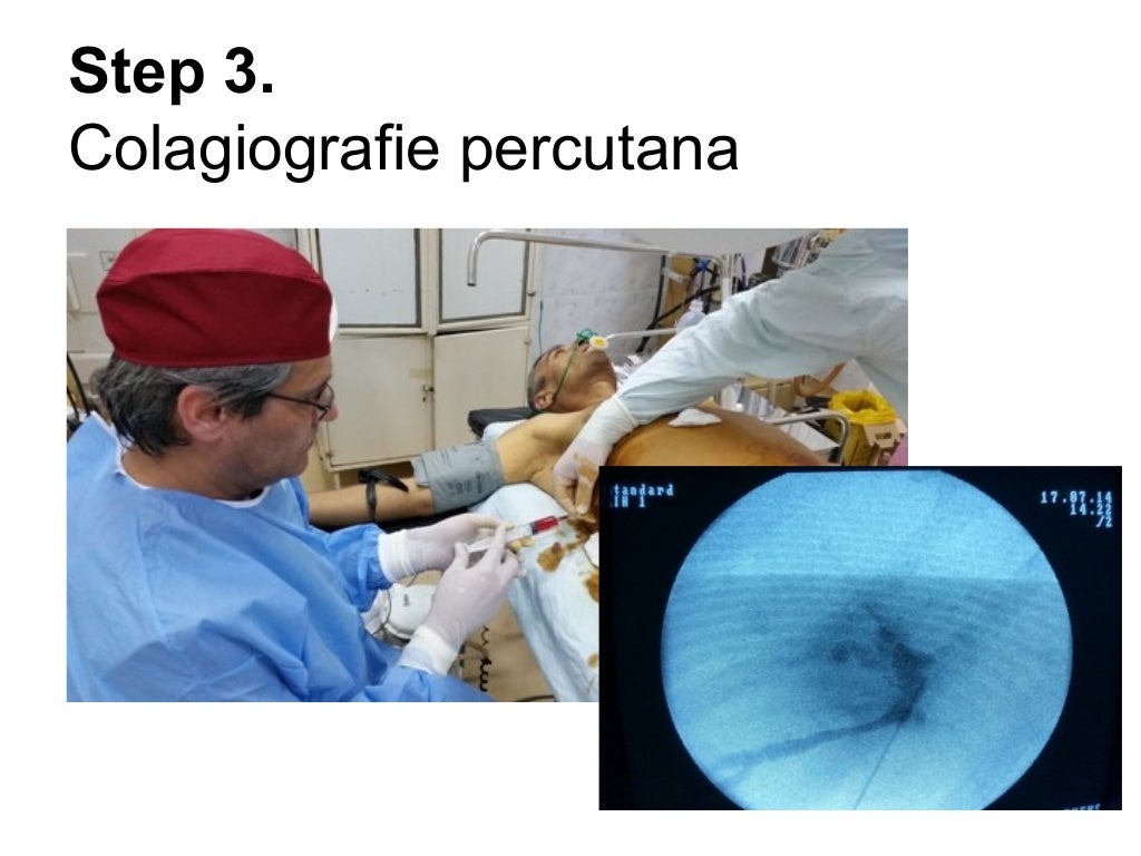 Colangiografie percutana transhepatica si drenaj biliar extern