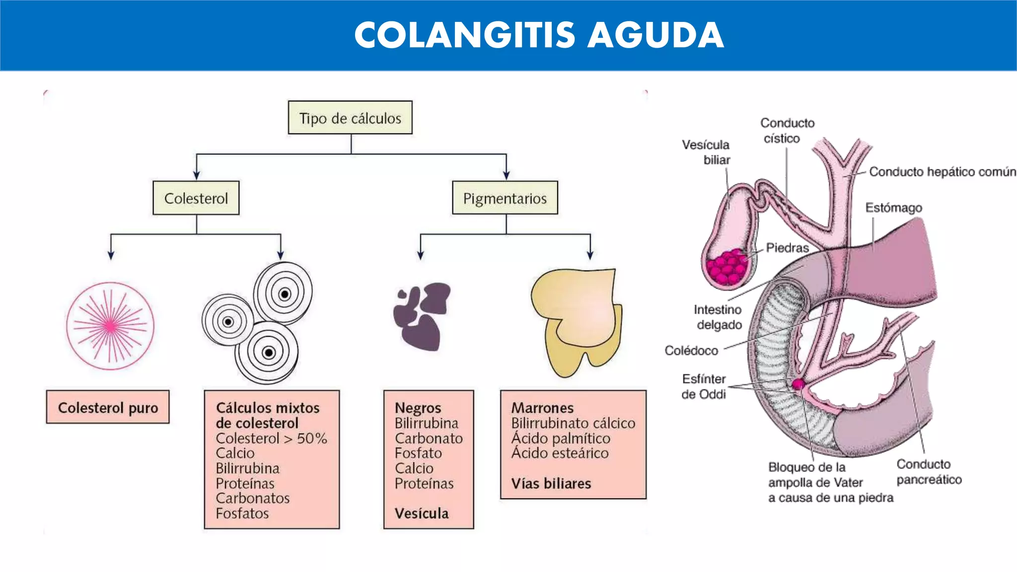 COLANGITIS AGUDA-CIRUGIA/concepto, etiologia, patogenia ...
