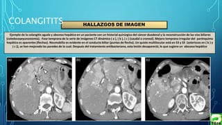 colangitis infections de vías biliar(1).pptx
