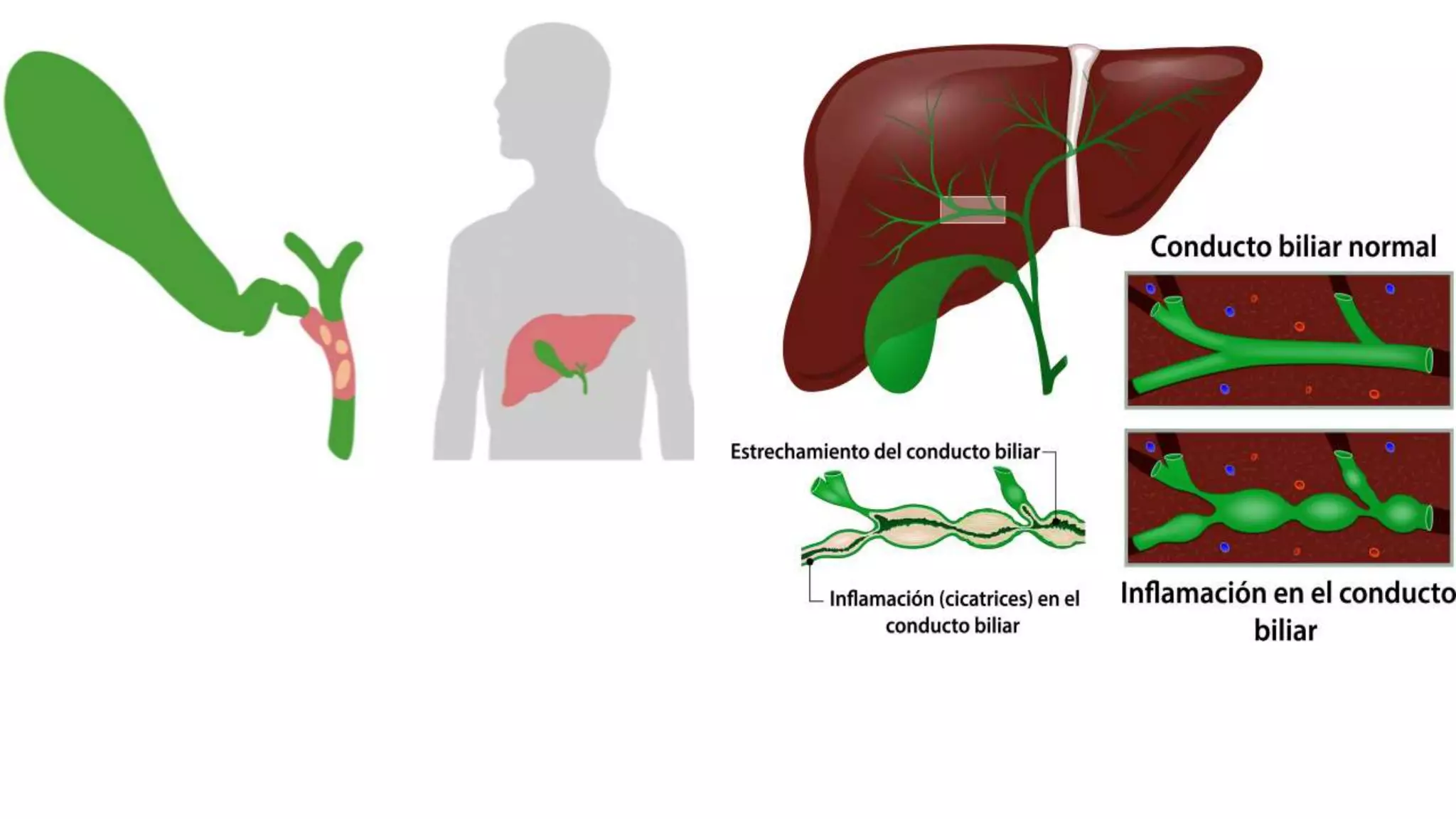 COLANGITIS AGUDA.pptx