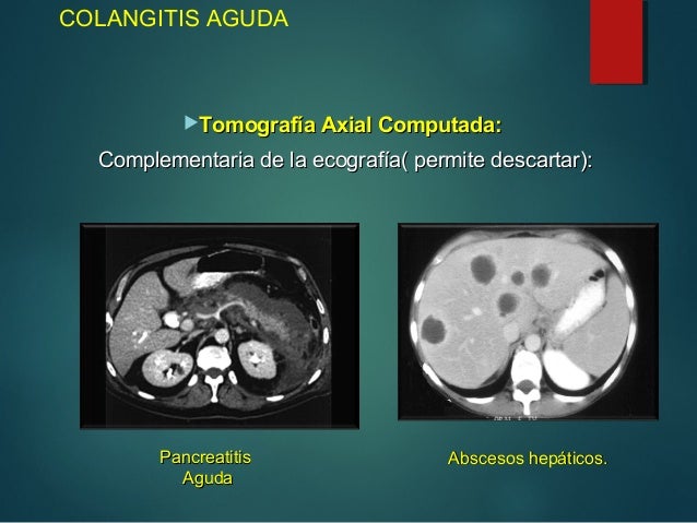 Colangitis aguda 2016
