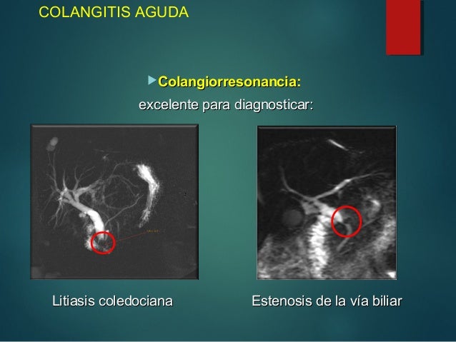 Colangitis aguda 2016