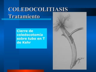 Colangitis aguda, colelitiasis y colesistitis | PPT