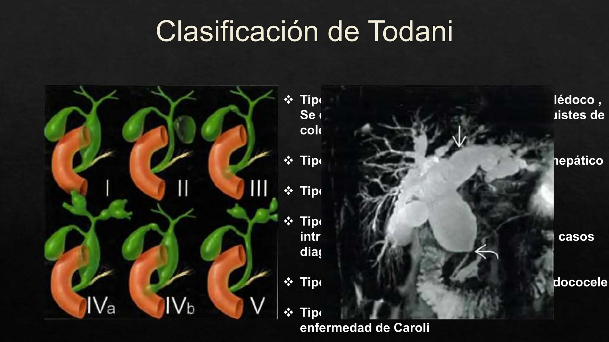 Colangitis , cirrosis biliar, sindrome de mirrizzi enfermedad de caroli ...
