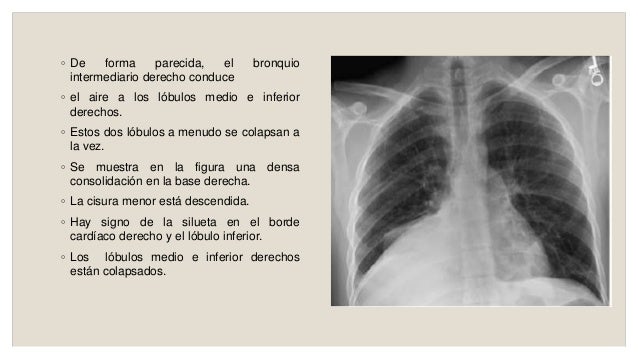 Colapso pulmonar