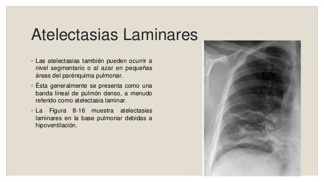Colapso pulmonar