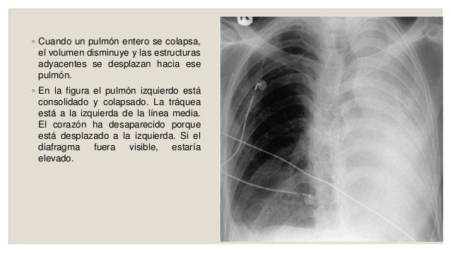 Colapso pulmonar