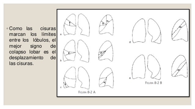 Colapso pulmonar