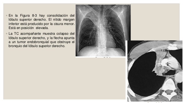 Colapso pulmonar