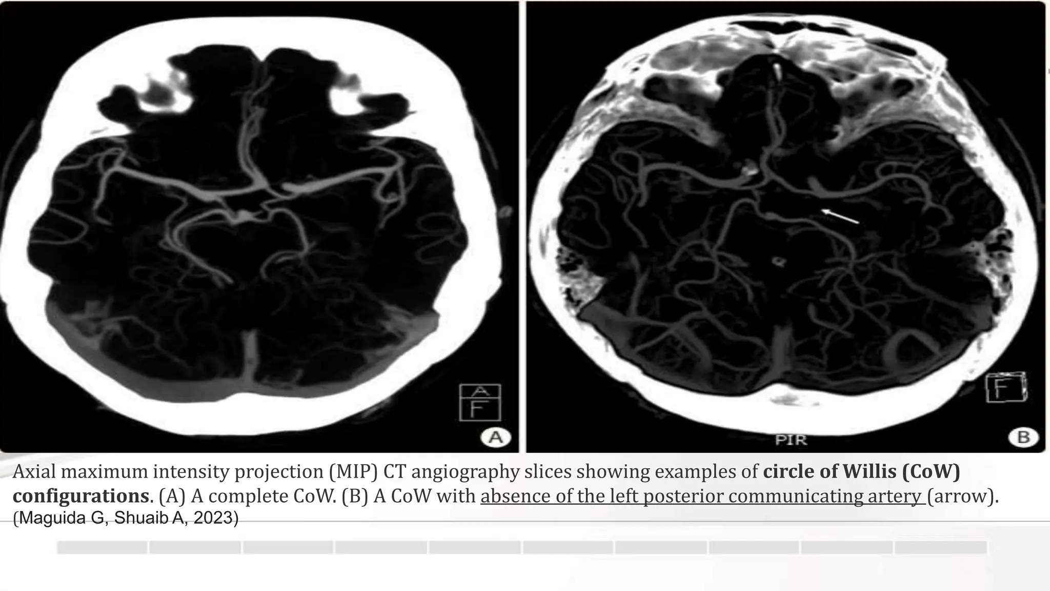 extracranial and intracranial cerebral collateral circulation .pptx