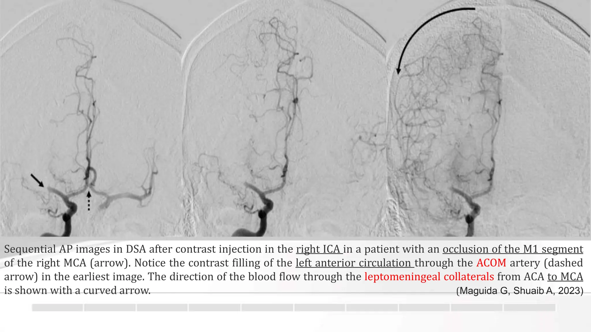 extracranial and intracranial cerebral collateral circulation .pptx