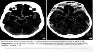 extracranial and intracranial cerebral collateral circulation .pptx