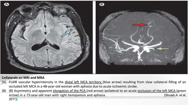 extracranial and intracranial cerebral collateral circulation .pptx