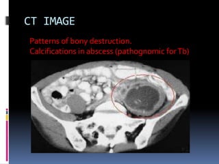 Cold abscess | PPTX
