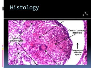 Cold abscess | PPTX