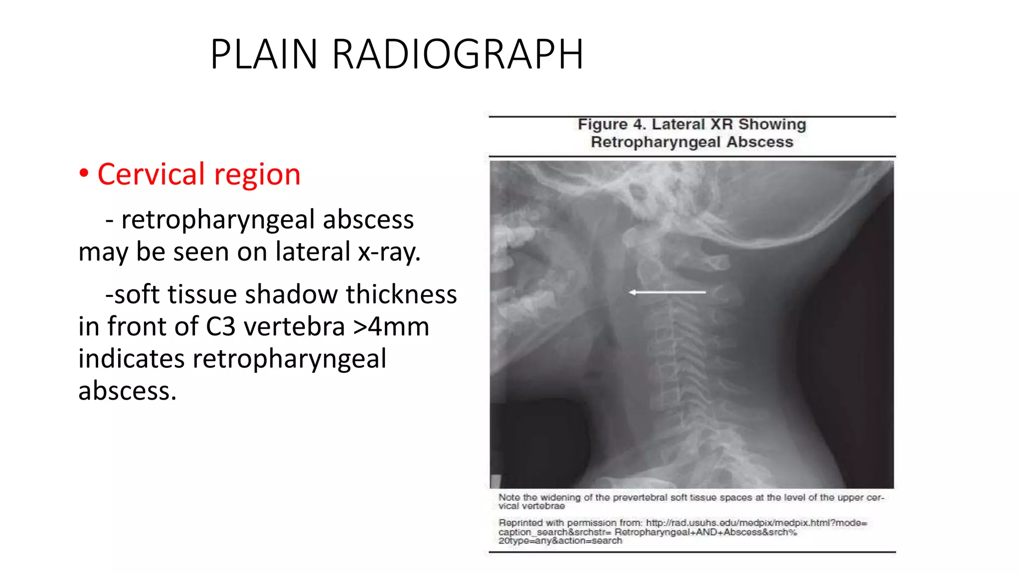Cold abscess | PPTX