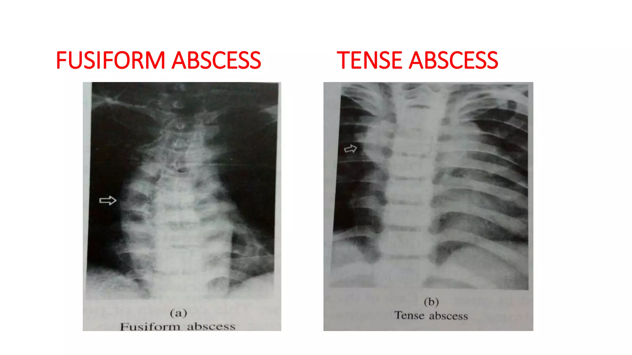 Cold abscess | PPTX