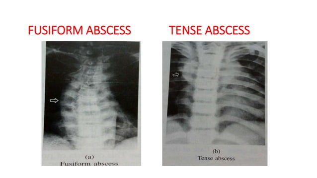 Cold abscess | PPTX