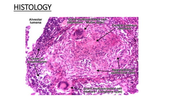 Cold abscess | PPT | Free Download