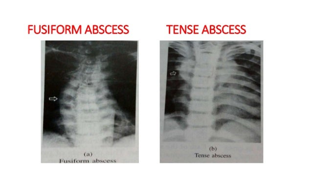 Cold abscess