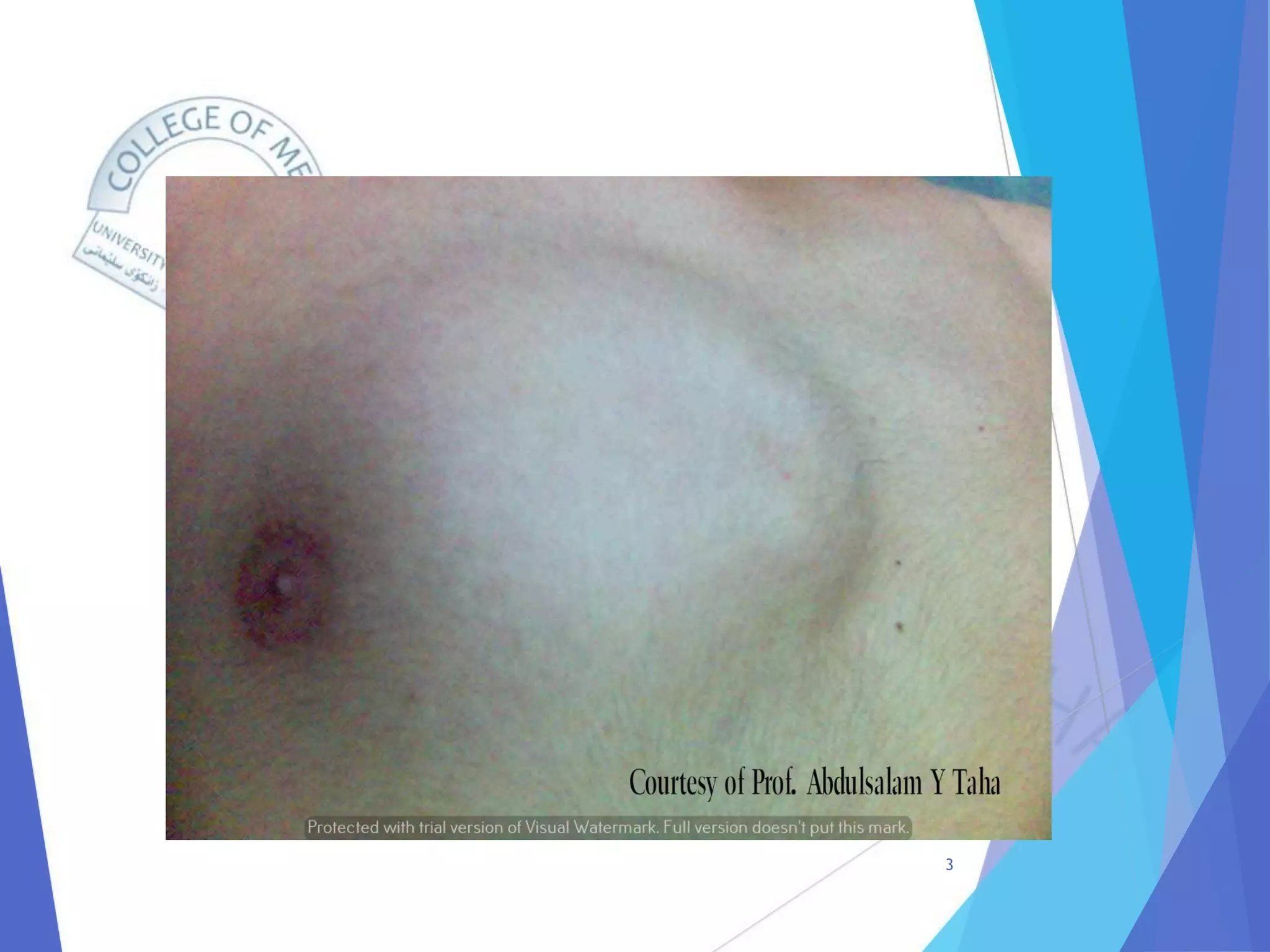 Cold Abscess of the Chest Wall.pdf