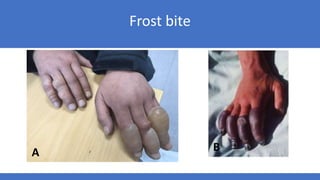 Cold and Heat Injuries-AUK.pptx heat and | PPTX
