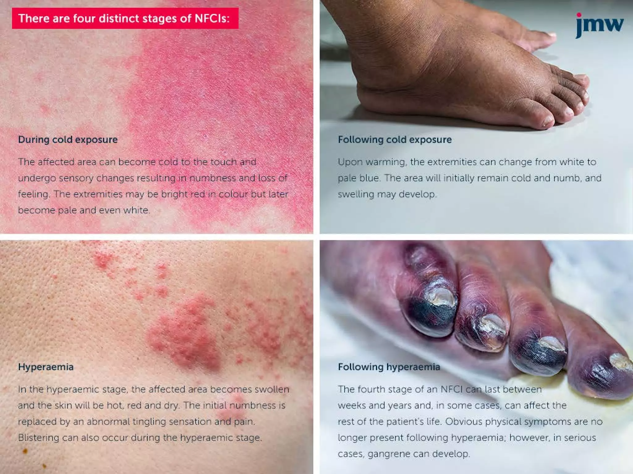 What are Non-freezing Cold Injuries? | PPT